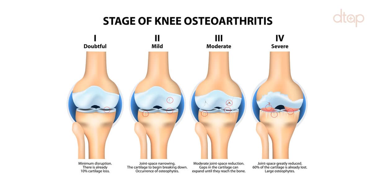 Top Knee Replacement Guide | Dr. Saksham Mittal